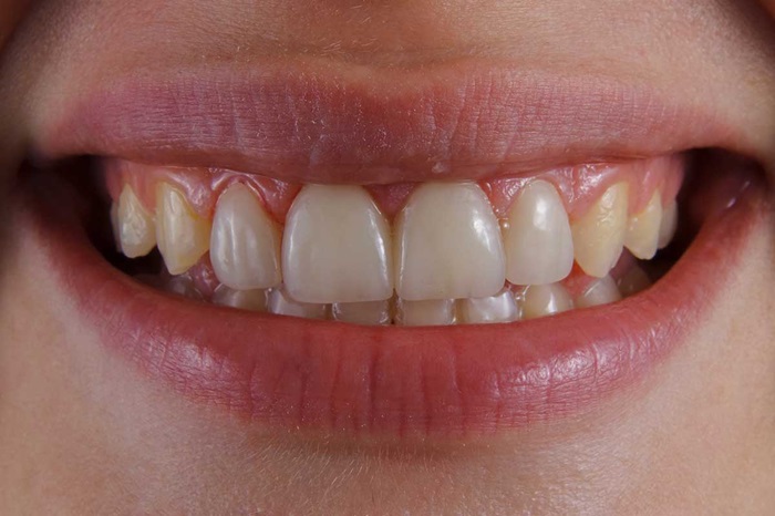 Câți dinți are un om? Despre structura dinților, dentiția temporară și ...